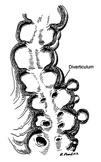 Diverticular Disease Information - Paul E. Savoca